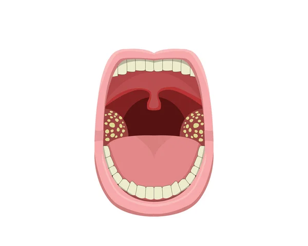 549 Tonsil Vector Images | Depositphotos