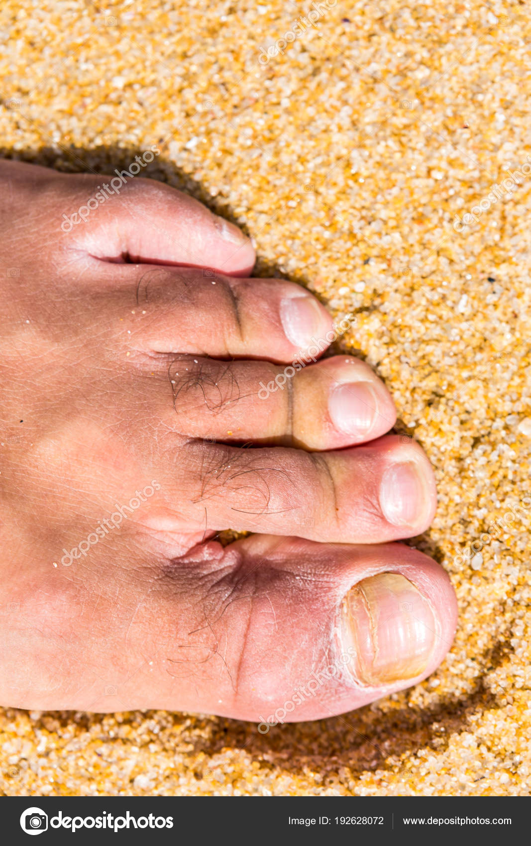 Ringworm. Mycosis to the toe. Beach sand background. Stock Photo by ...