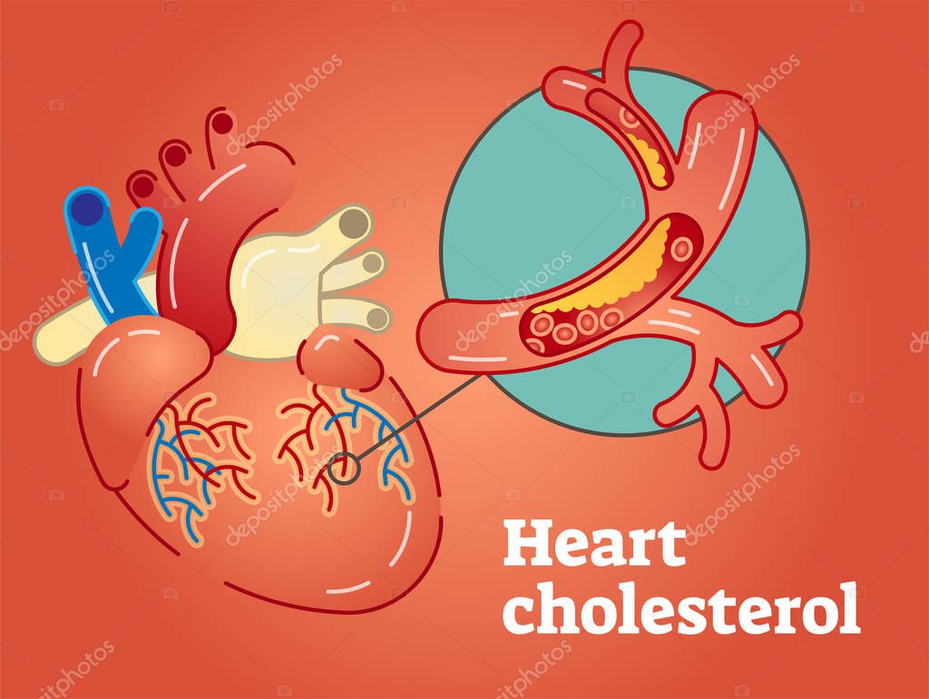 Imágenes: colesterol animadas | Concepto de colesterol corazón — Vector ...