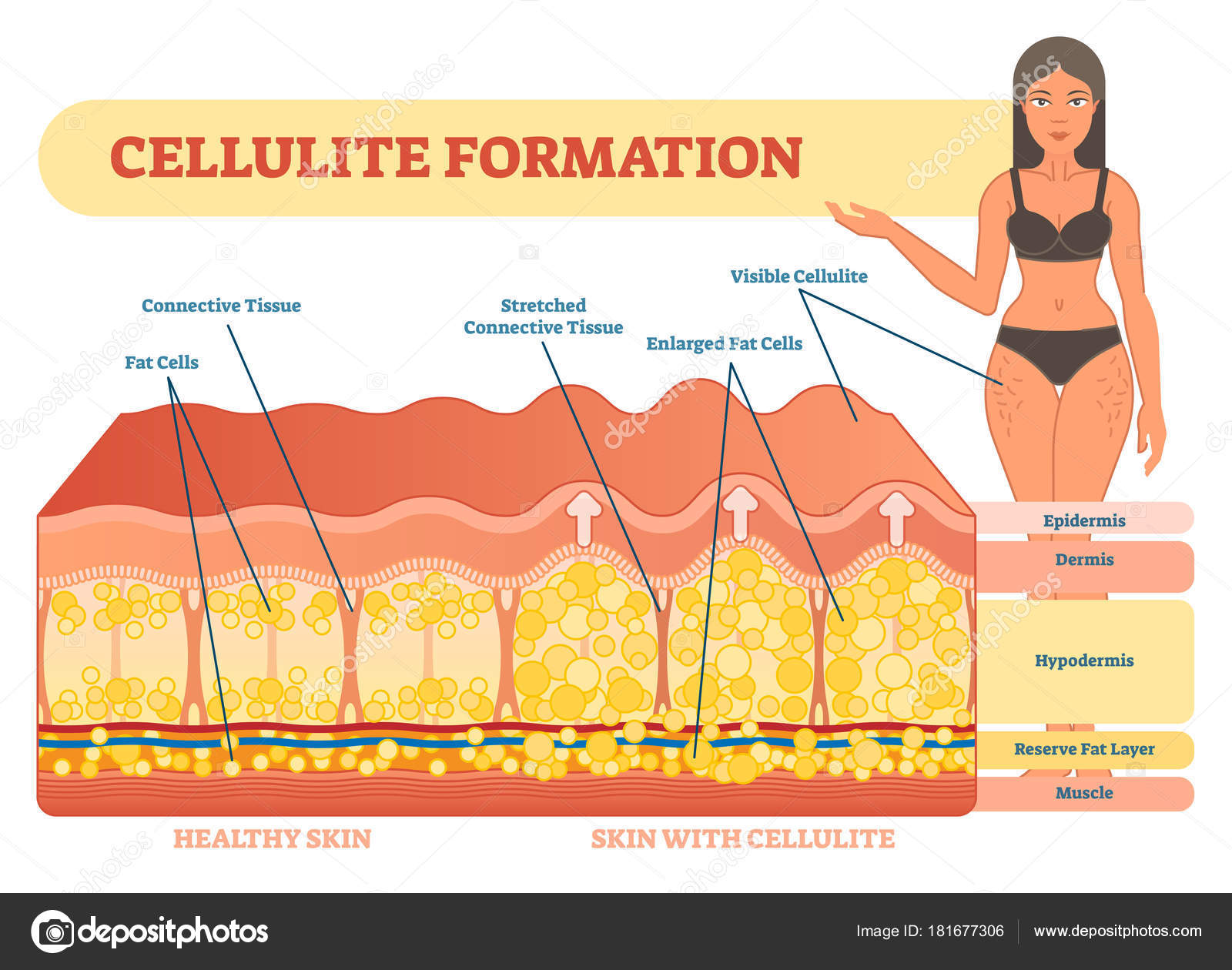 Cellulite formation vector illustration diagram, medical information ... Cellulite formation vector illustration diagram, medical information ...