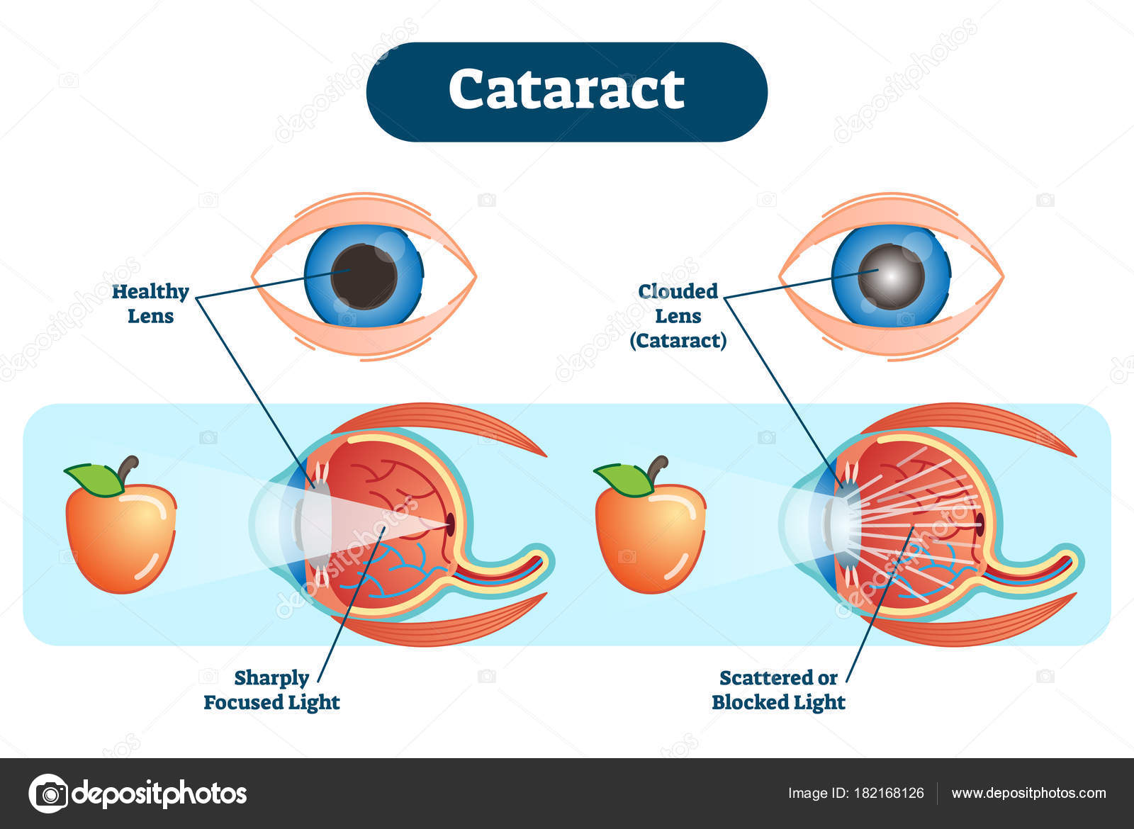 Cataract vector illustration diagram, anatomical scheme. Stock Vector ...