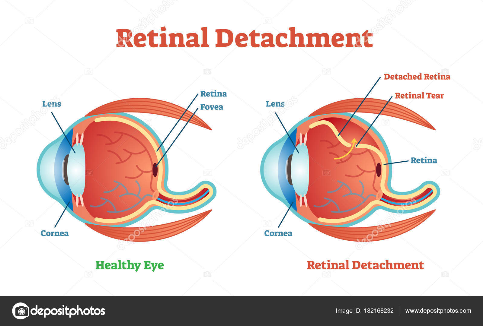 Diagrama de ilustración del vector de desprendimiento de retina ...