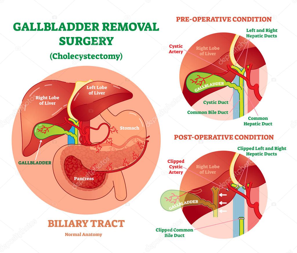 Colecistectom a: cirug a de extirpaci n de la ves cula biliar, diagrama de ilustraci n del ...