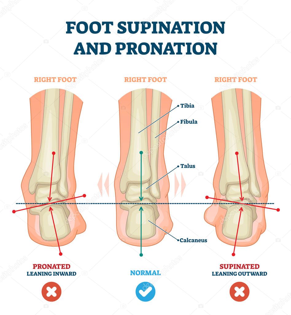 Pies supinación y pronación vector ilustración. Esquema médico ...