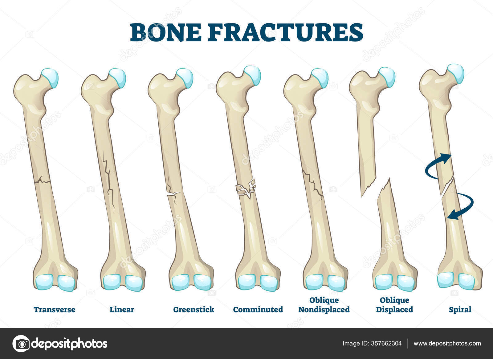 Bone fractures vector illustration. Labeled various broken leg or arm ... Bone fractures vector illustration. Labeled various broken leg or arm ...