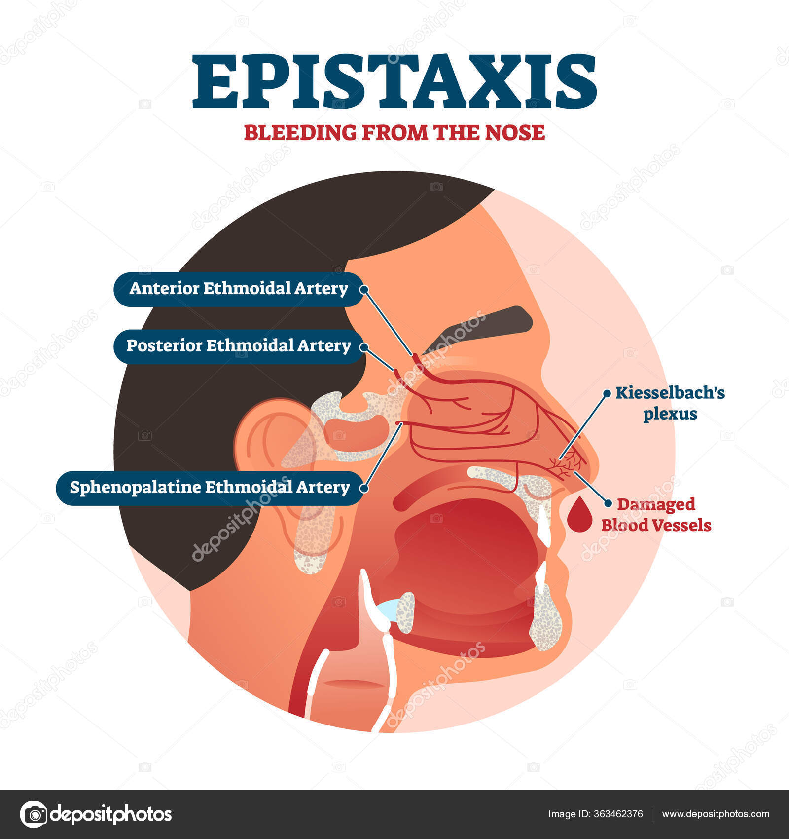 Epistaxis vector illustration. Bleeding from nose explanation health scheme Stock Vector by ...
