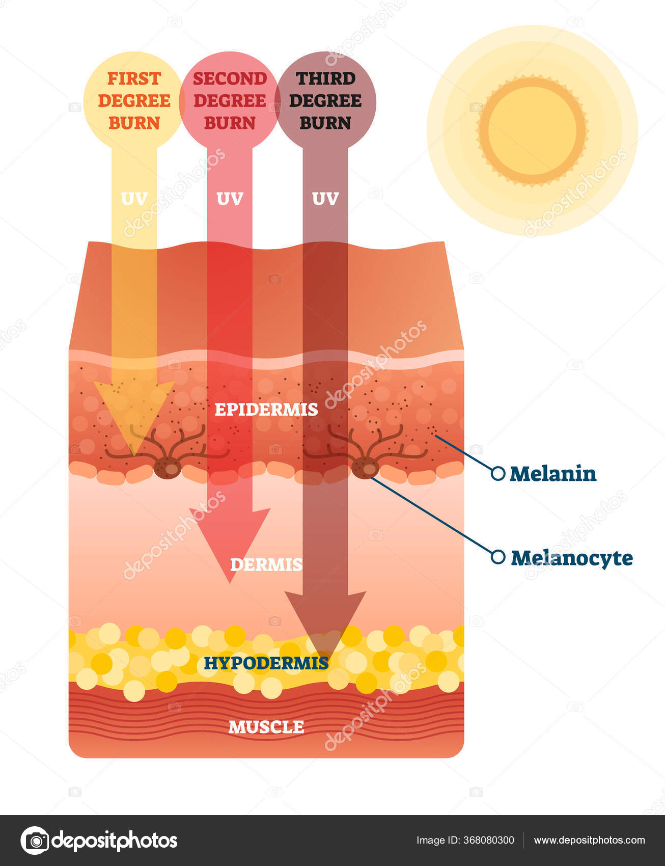 Sunburn skin damage anatomical cross section diagram Stock Vector Image ...