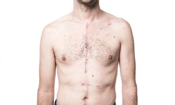 Pictures : open heart surgery scar | Some Scar from open heart surgery ...