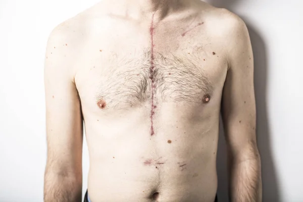 Some Scar from open heart surgery in studio — Stock Photo © Lopolo ...