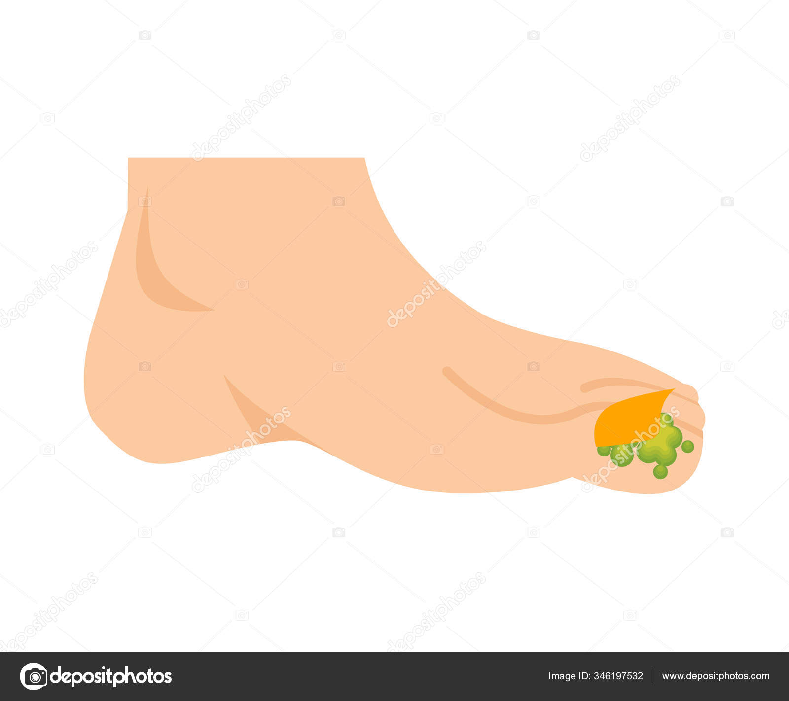 Fungus Legs Nail Disease Toe Infection Vector Illustration Stock Vector ...