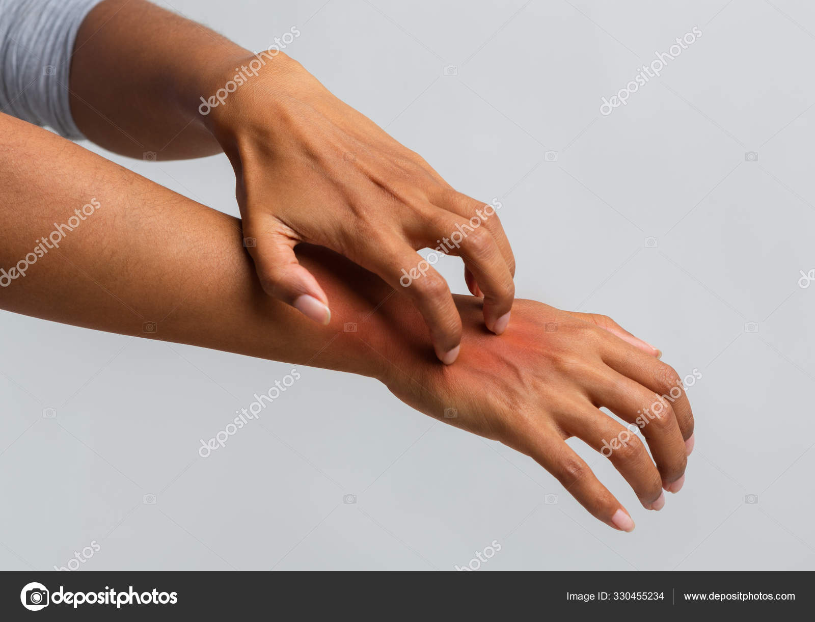Woman scratching her hand, suffering from psoriasis Stock Photo by ...