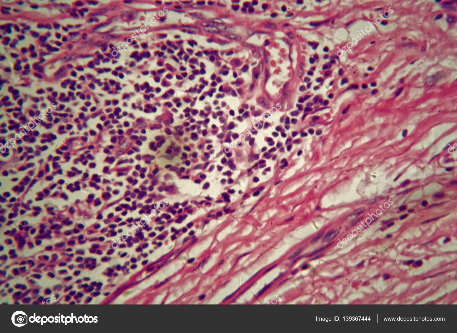 Microscopic Images Of Cancer Cells