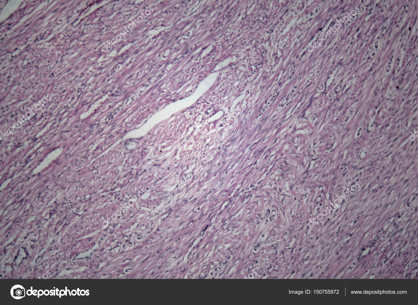 Cells of human uterus tissue with inoffensive tumor cells Stock Photo ...