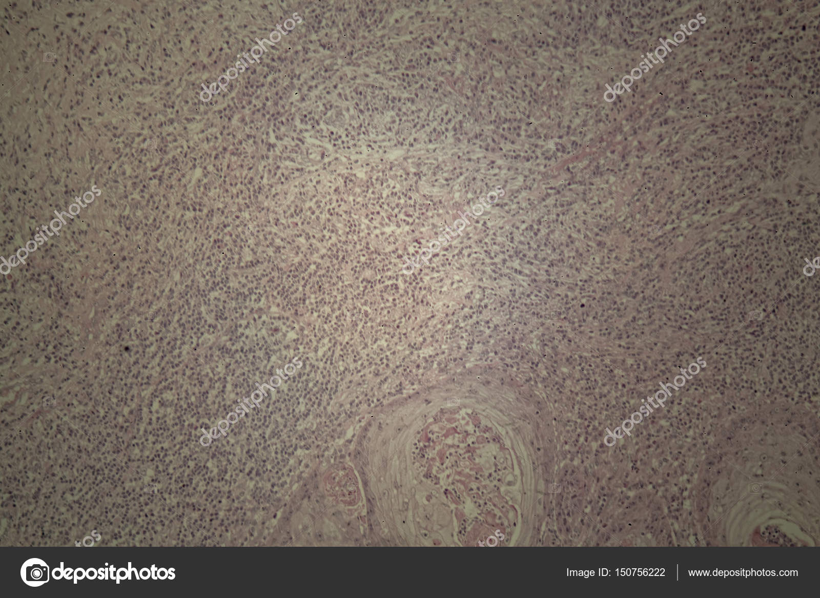 Human skin with squamous cell carcinoma — Stock Photo © ChWeiss #150756222
