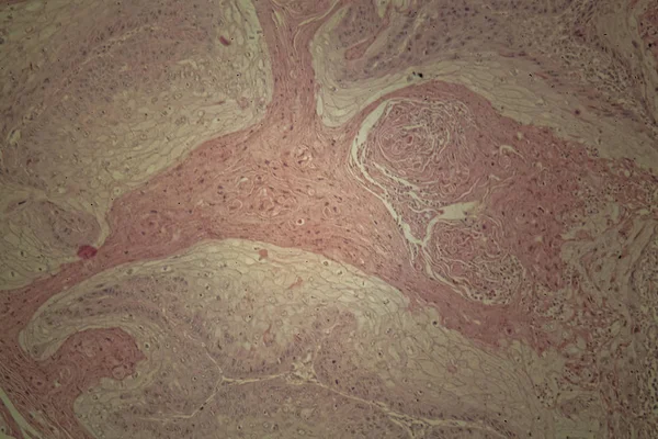 Human skin with squamous cell carcinoma - Stock Image - Everypixel