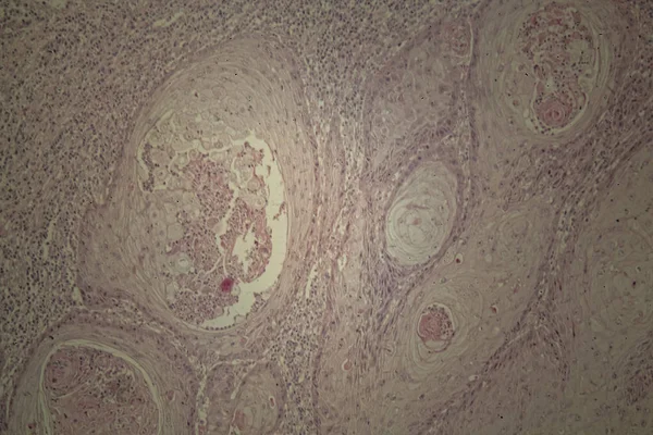 Squamous cell Stock Photos, Royalty Free Squamous cell Images ...