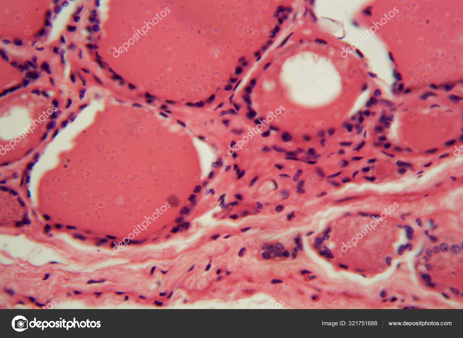 Cells of a human thyroid gland with swelling under a microscope. ⬇ ...
