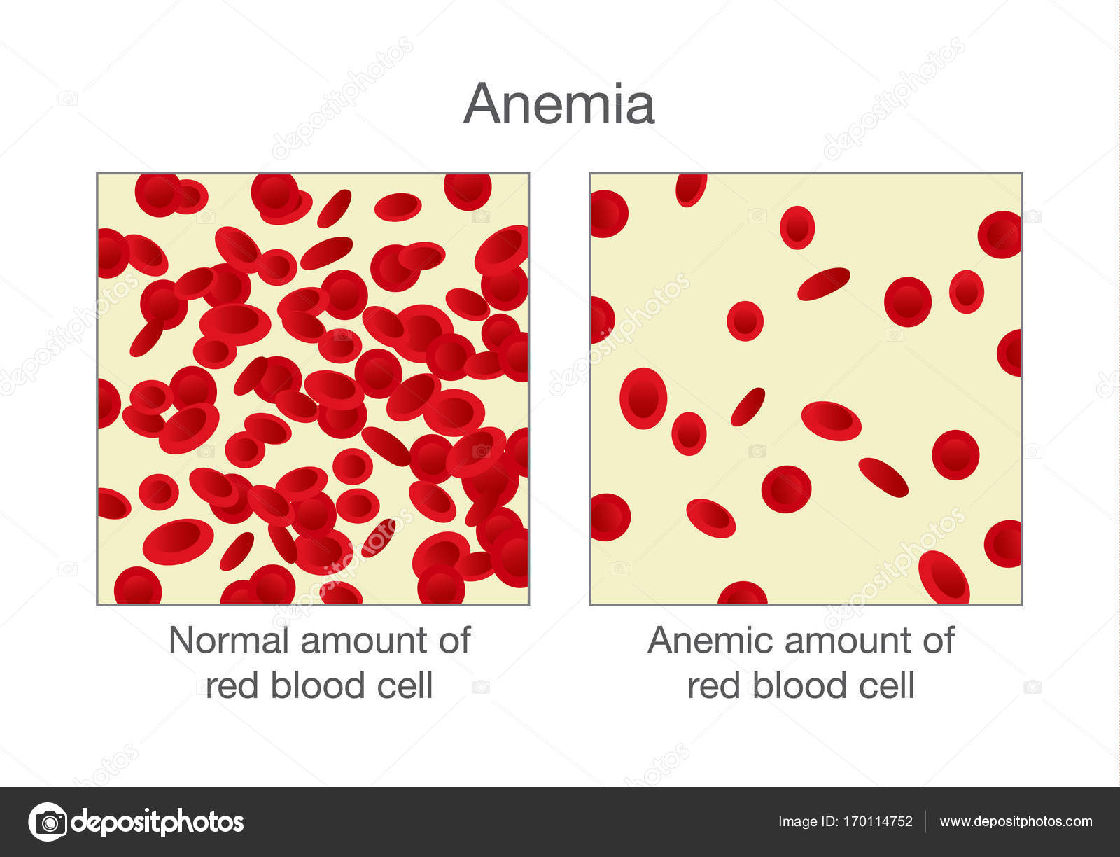 Perbedaan jumlah normal sel darah merah dan Anemia . Vektor Stok oleh ...