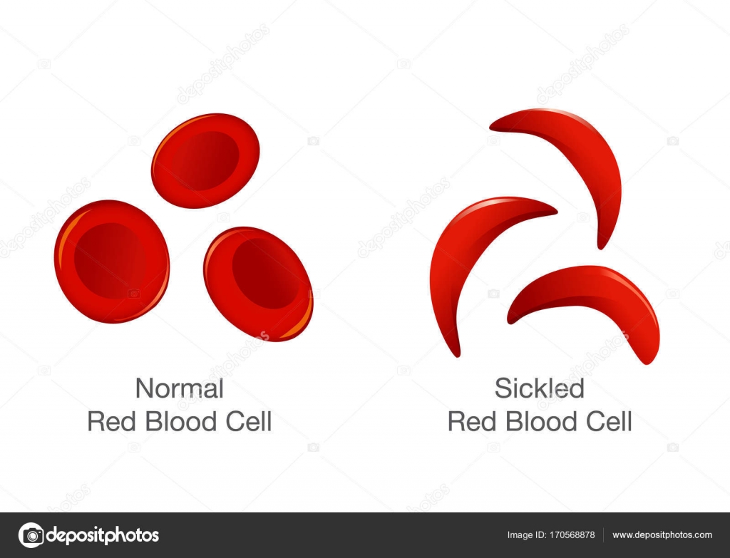 The difference of Normal red blood cell and sickle cell. Stock Vector ...