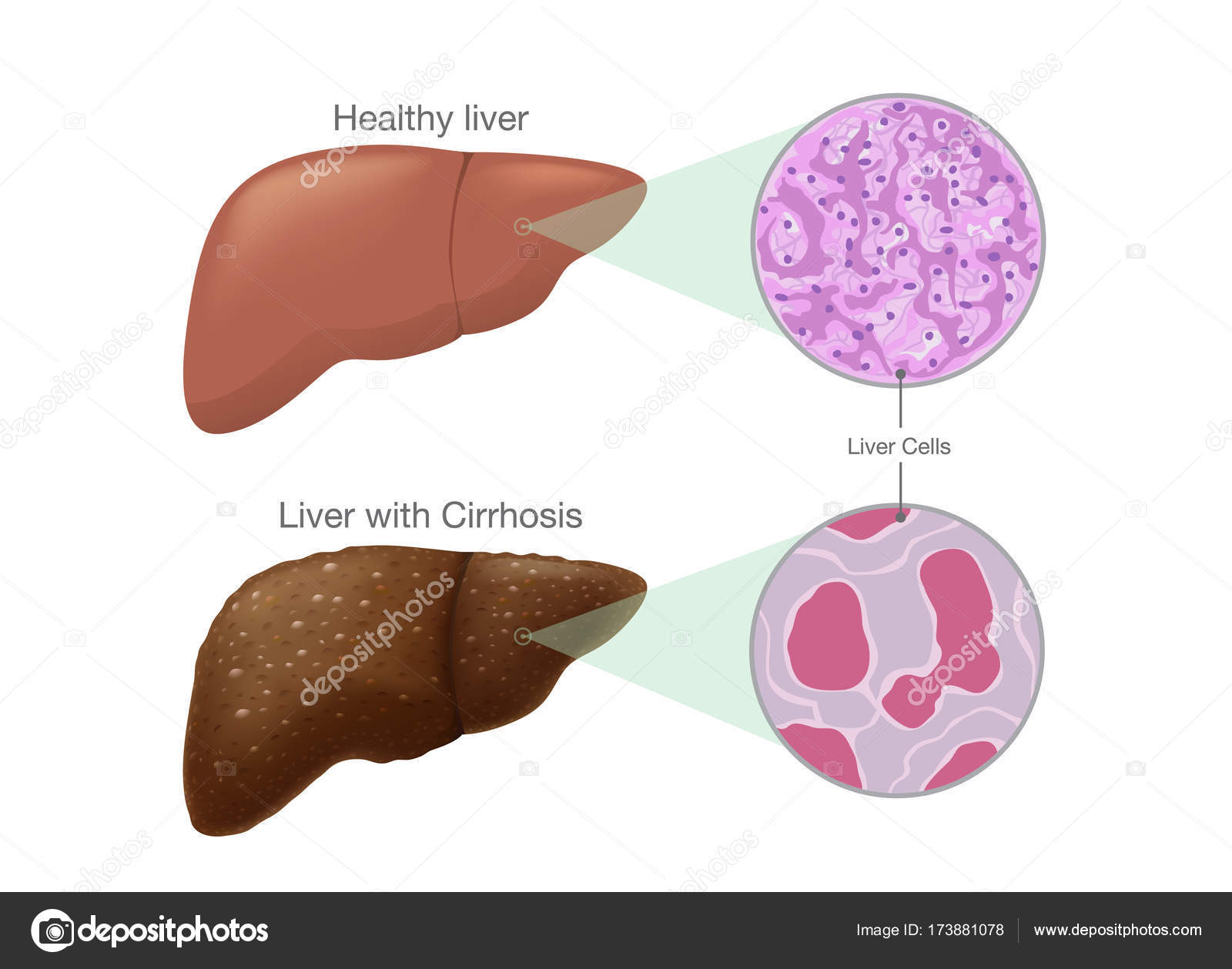 Het verschil tussen gezonde levercellen en levercirrose — Stockvector ...