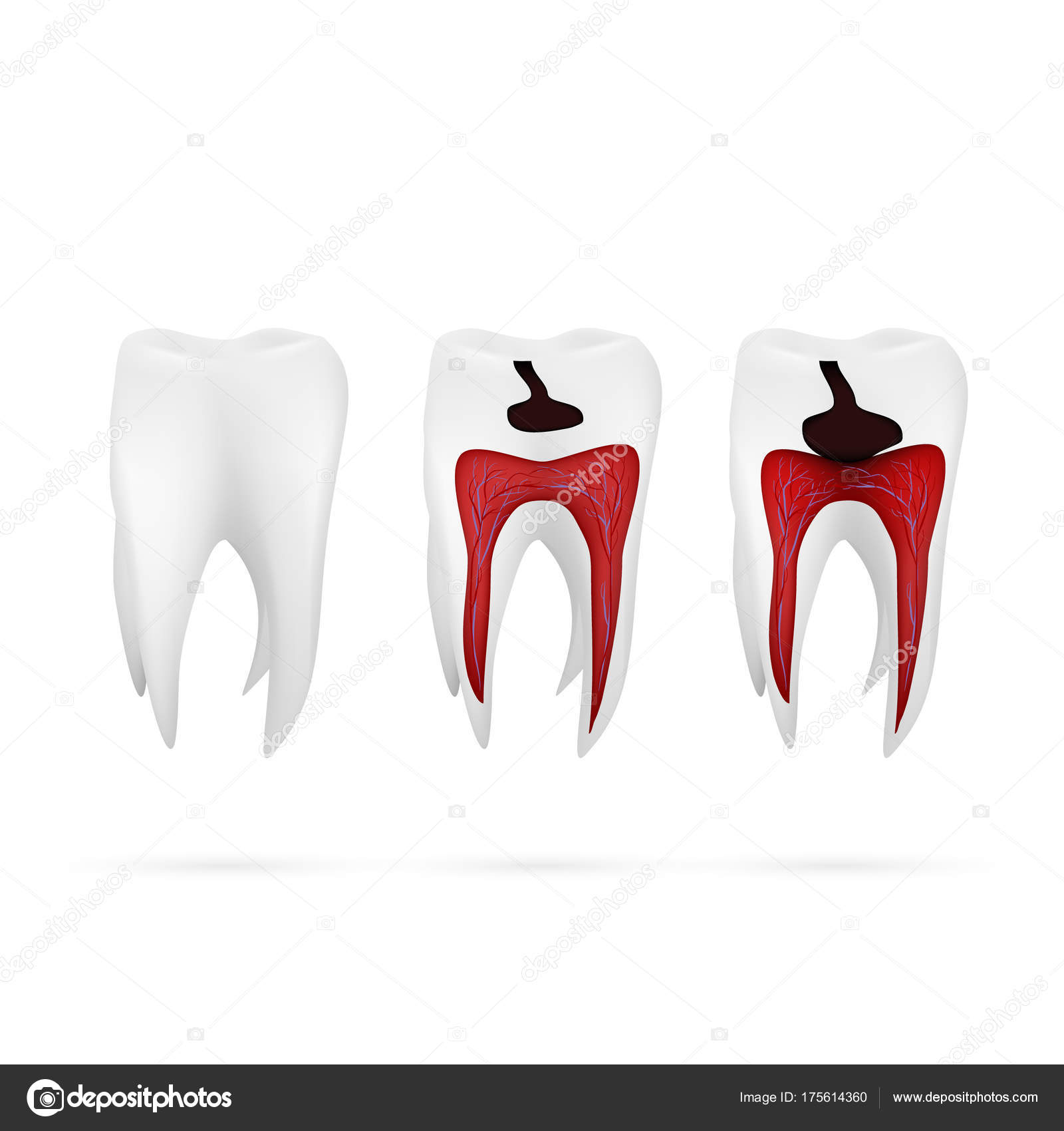 Stages Of Caries Development Isolated On White Stock Vector Image by ...