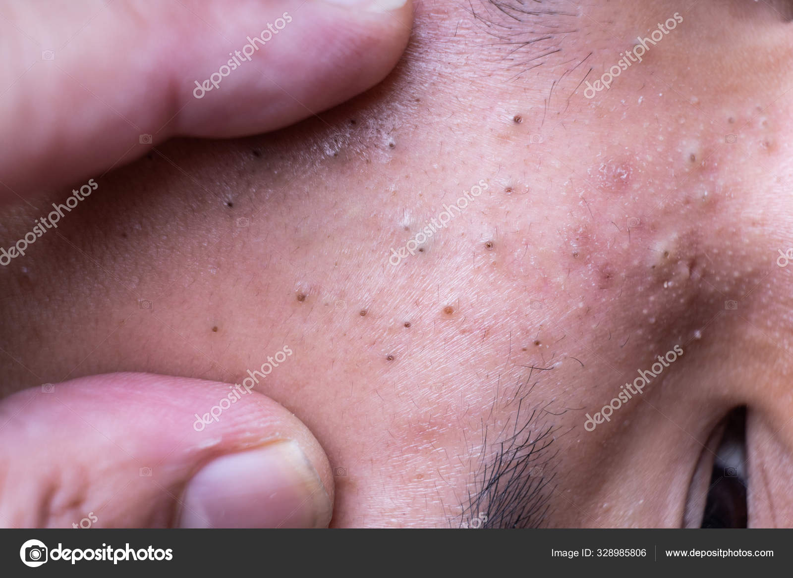 Acne Blackheads