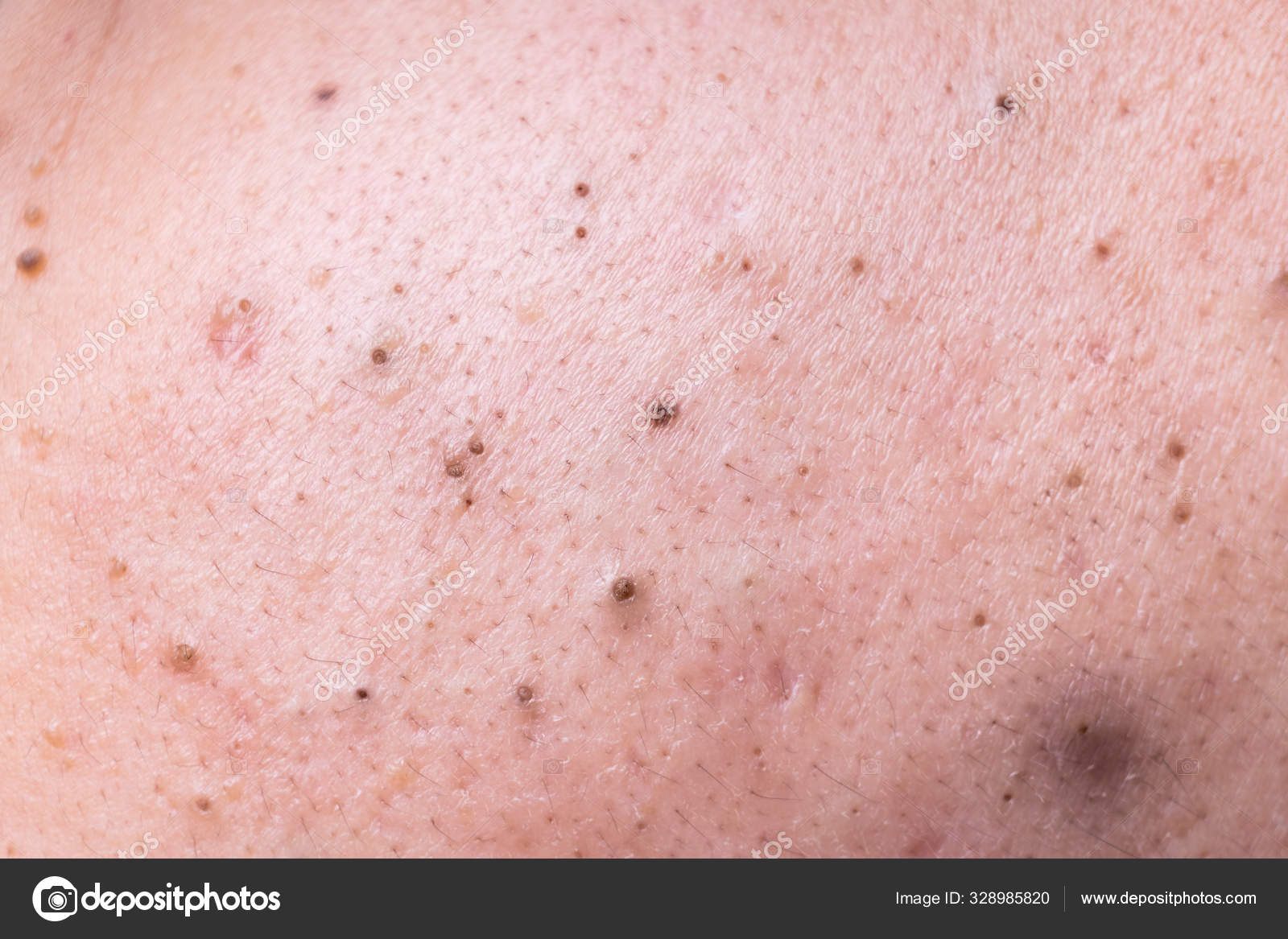 Blackheads On Face