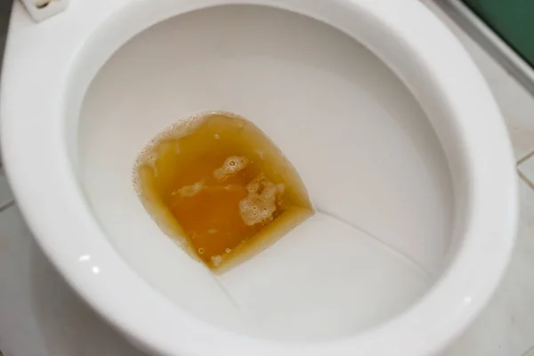 Watery Diarrhea In Toilet