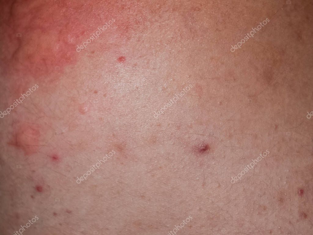 Alergia en la piel y los lados. Reacciones alérgicas en la piel en ...
