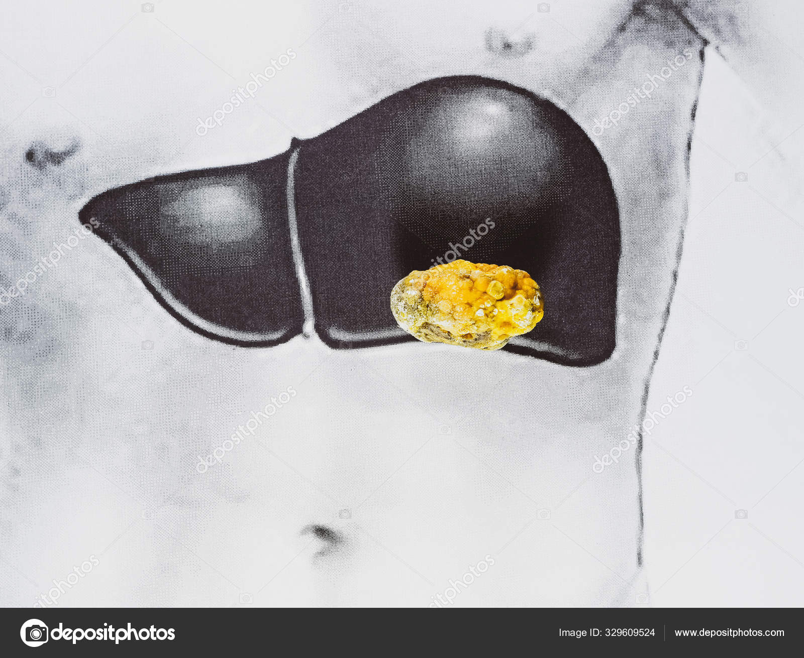 Stone in the liver, schematic image, a large gallstone, the result of ...