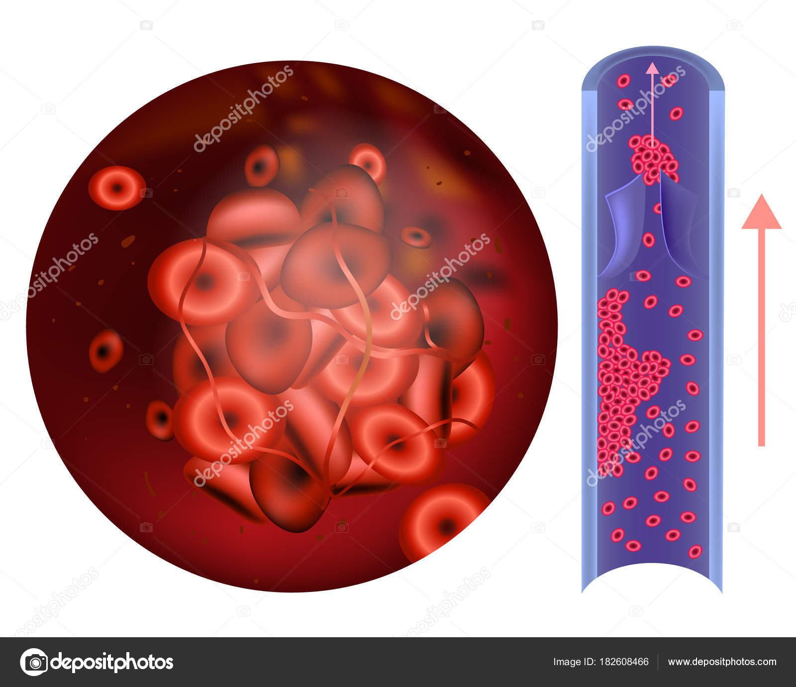 Prothrombin Thrombophilia Sometimes Hypercoagulability Prothrombotic ...
