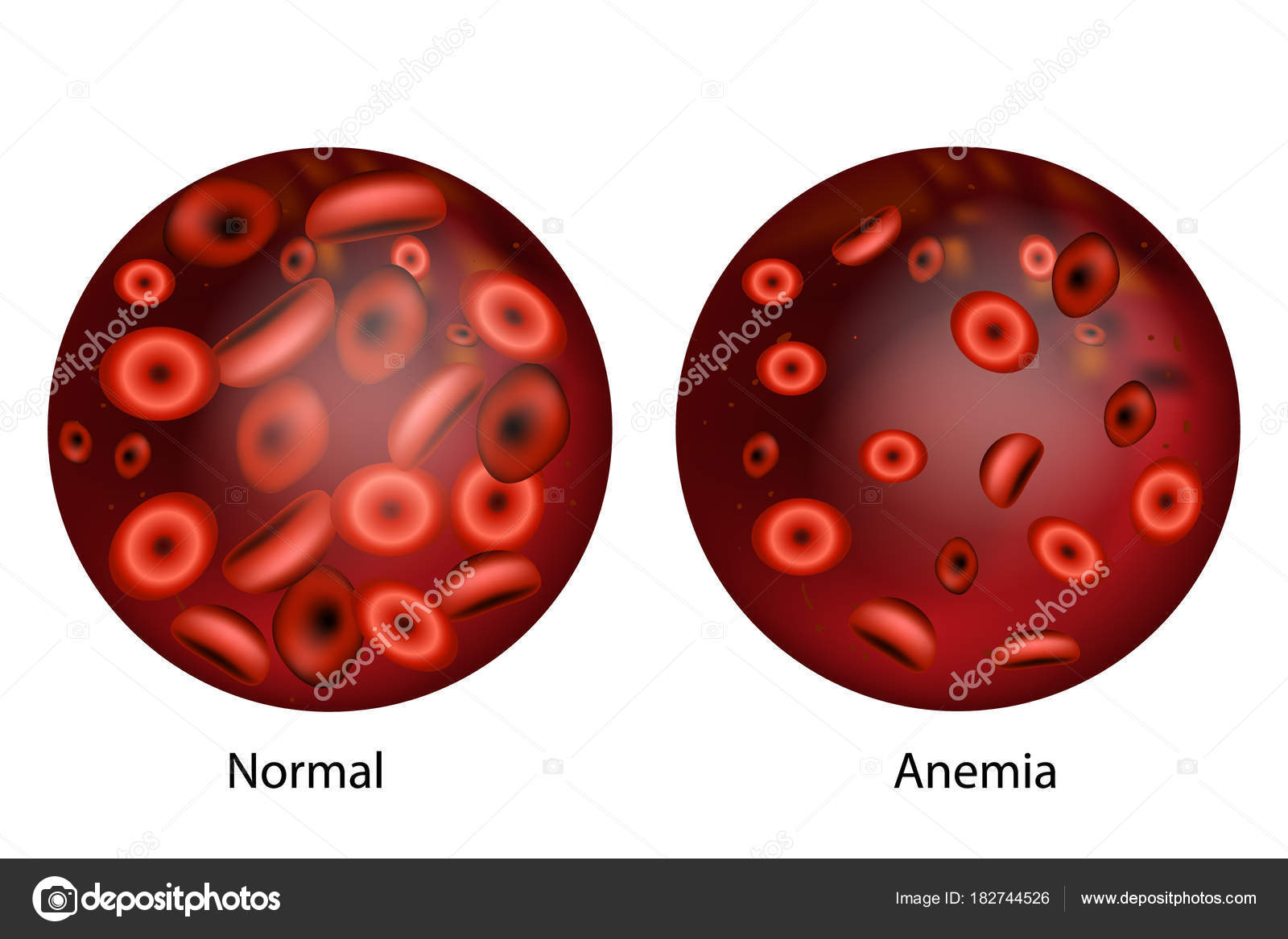 Iron Deficiency Anemia Difference Anemia Amount Red Blood Cell Normal ... Iron Deficiency Anemia Difference Anemia Amount Red Blood Cell Normal ...
