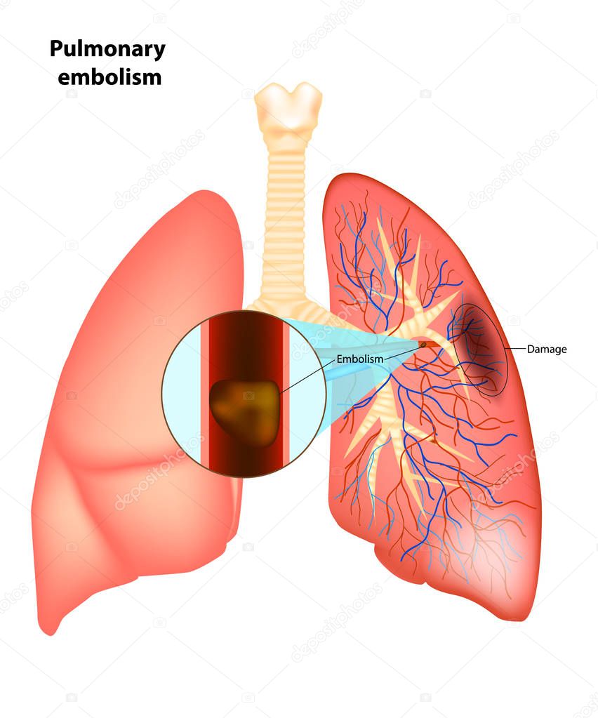 Embolia pulmonar. Ilustración vectorial 2022