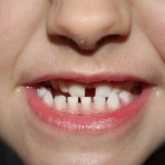 Bad teeth Stock Photo by ©Reanas 2939910