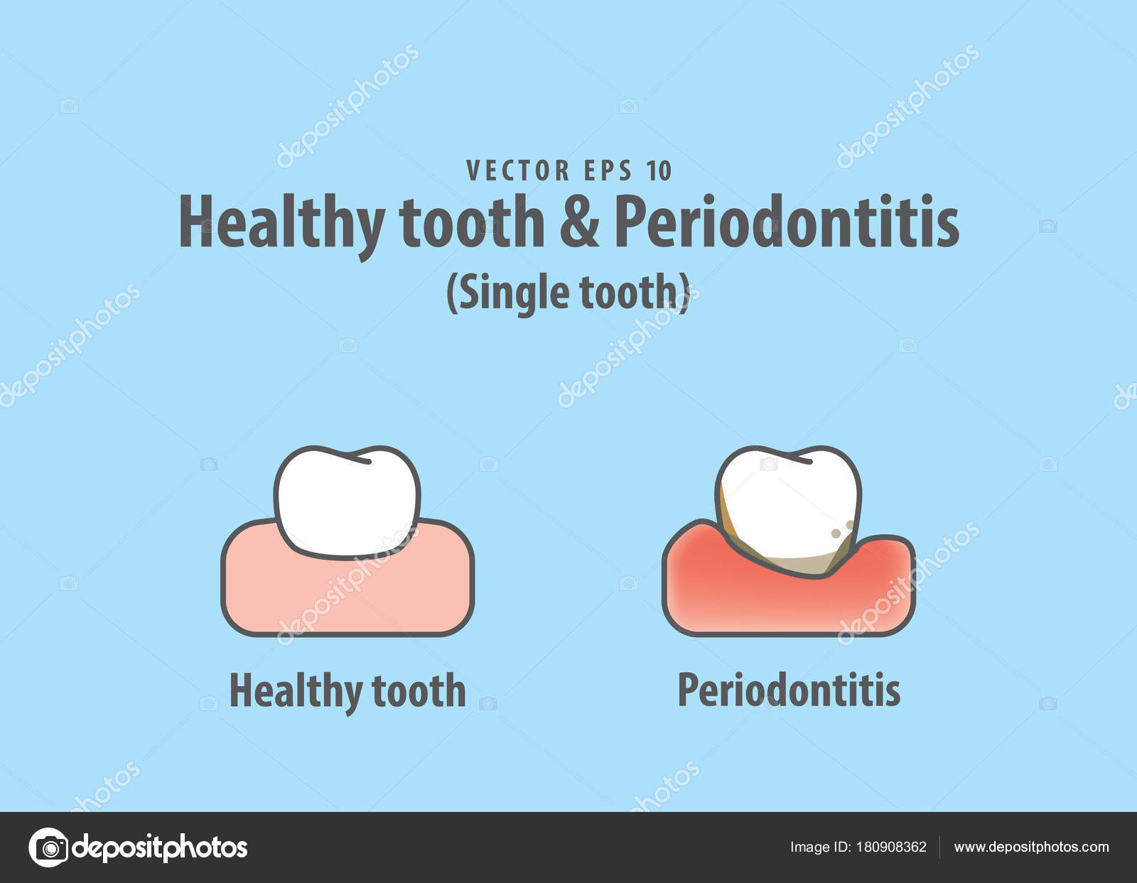 Healthy tooth & Periodontitis (Single tooth) illustration vector Stock ...
