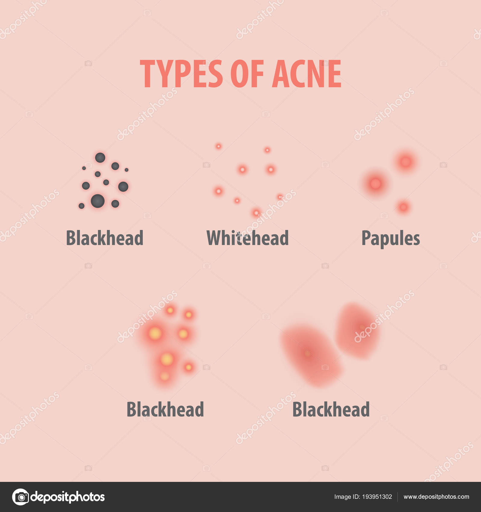 Types Of Acne Illustration Vector On Pink Background Beauty Con Stock