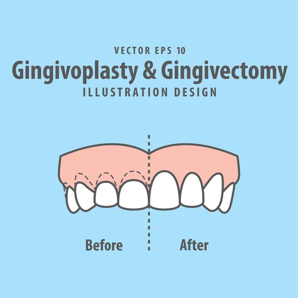 Excision Vector Art Stock Images | Depositphotos Excision Vector Art Stock Images | Depositphotos