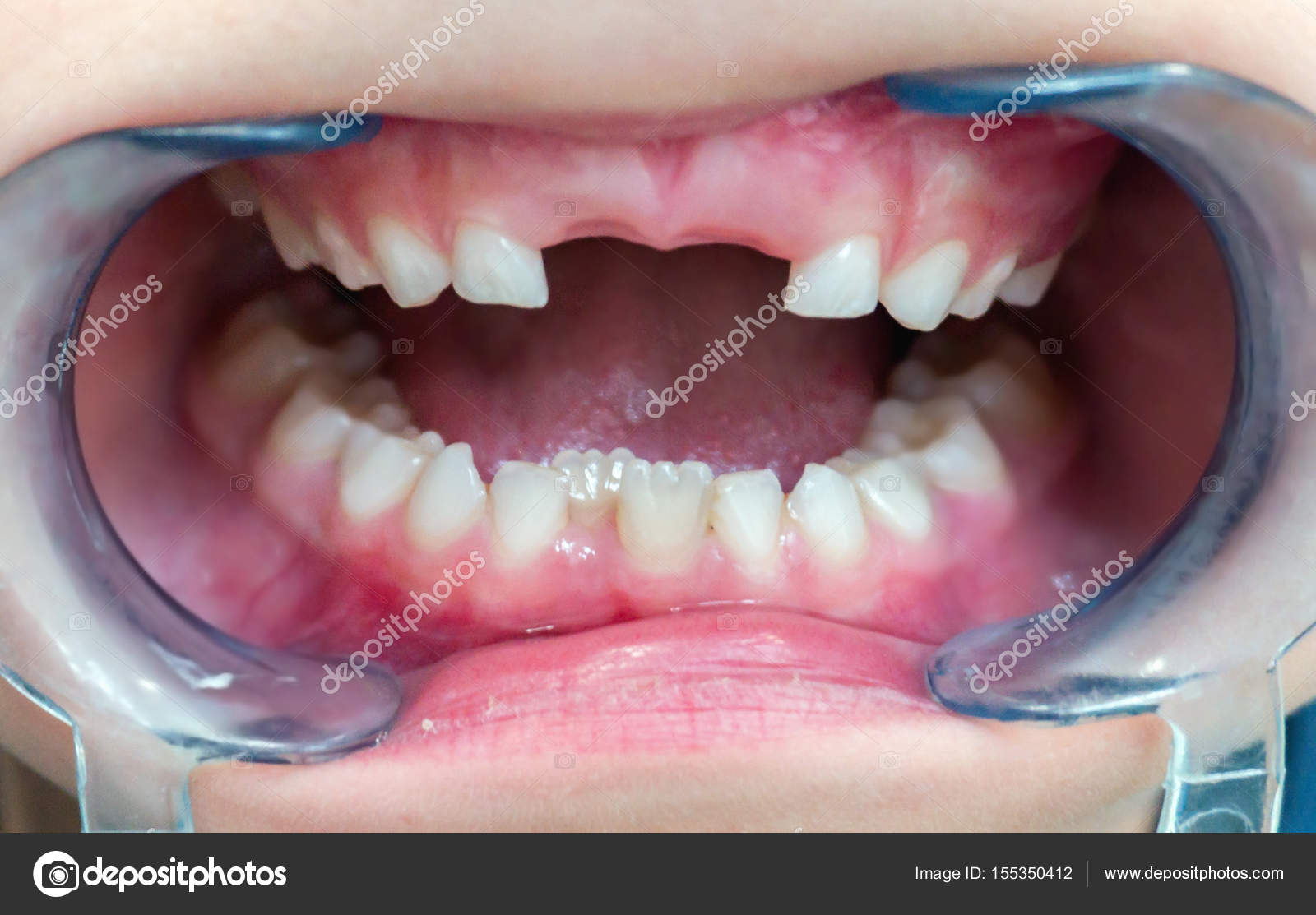Little child's broken teeth — Stock Photo © agephotography #155350412