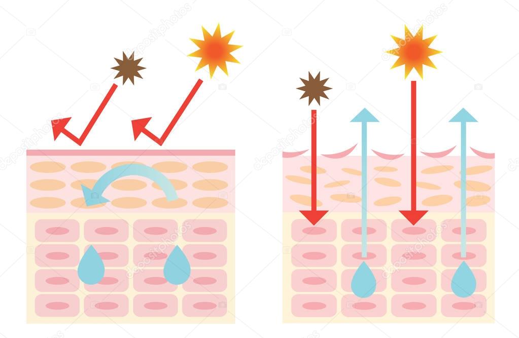 Infographic skin illustration. healthy skin and dry skin mechanism ...