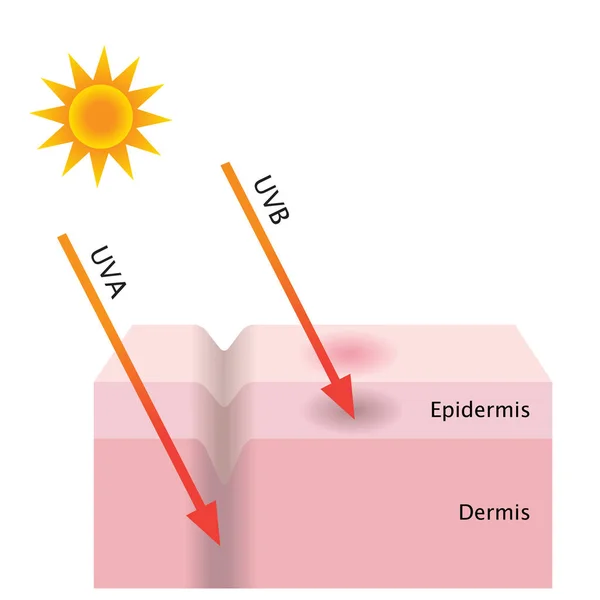 Infographic skin illustration. the difference between UVA and UVB rays ...