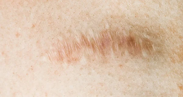 Skin scar keloid - mlhalast