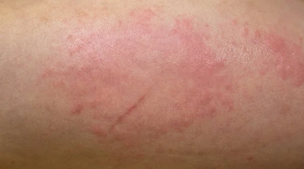 Itchy Rash All Over Body