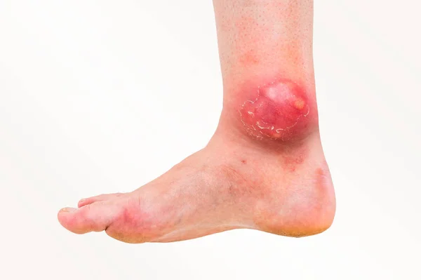 Skin boil Stock Photos, Royalty Free Skin boil Images | Depositphotos