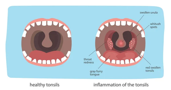 Bakteriyel farenjit Stock Photos, Royalty Free Bakteriyel farenjit ...