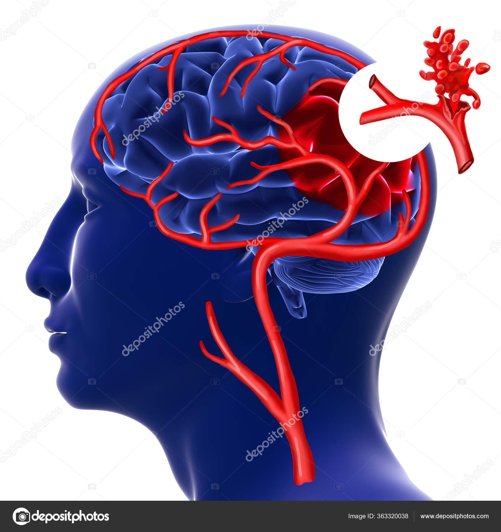 Hemorragia Cerebral Renderizado: fotografía de stock © 100502500 ...