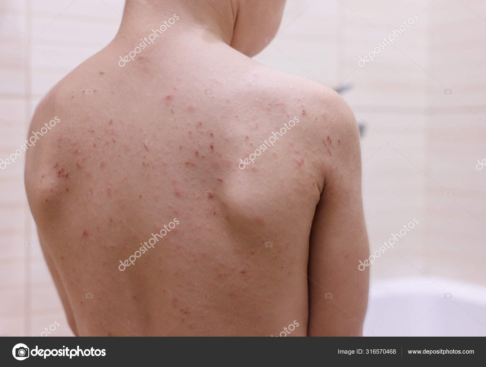 Child's back. Eczema atopic dermatitis symptom skin. Symptom. — Stock ...