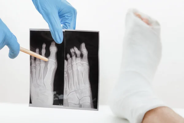 Doctor showing patient x-ray image of a broken finger,leg in plaster ...