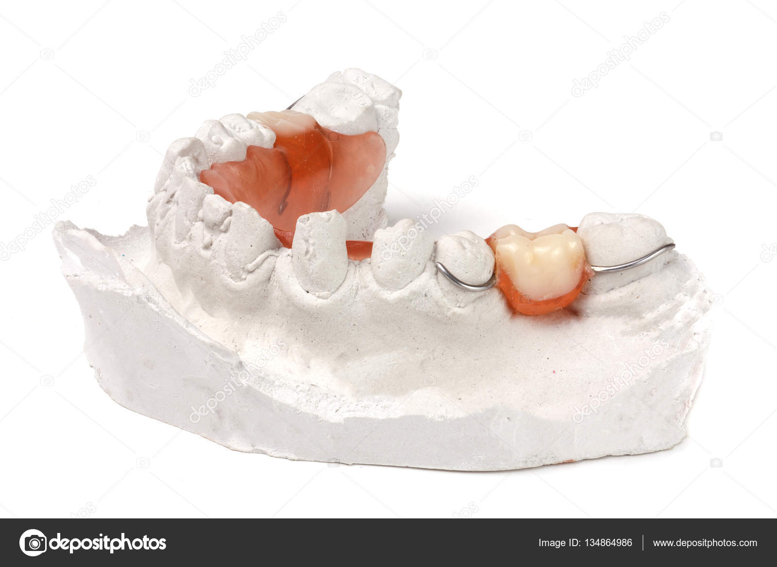 Plaster cast of teeth with removable partial denture isolated on white ...