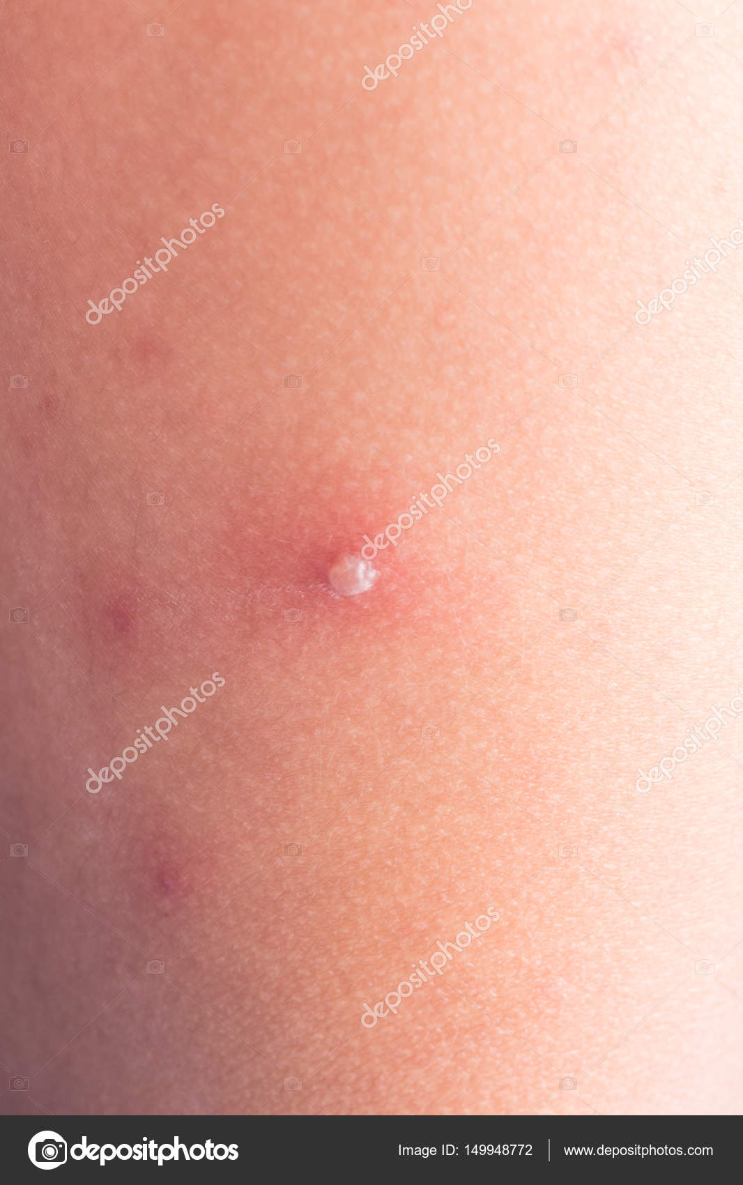 Chicken pox rash — Stock Photo © stockphototrends #149948772