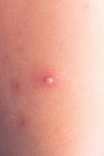 Pox Stock Photos, Royalty Free Pox Images | Depositphotos®